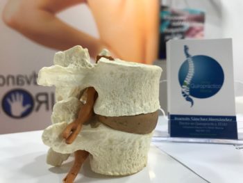 Subluxación: definición, efectos, síntomas y causas. - QuiroMurcia