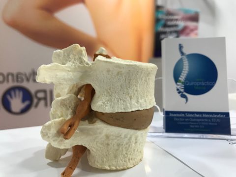 Subluxación: definición, efectos, síntomas y causas. - QuiroMurcia